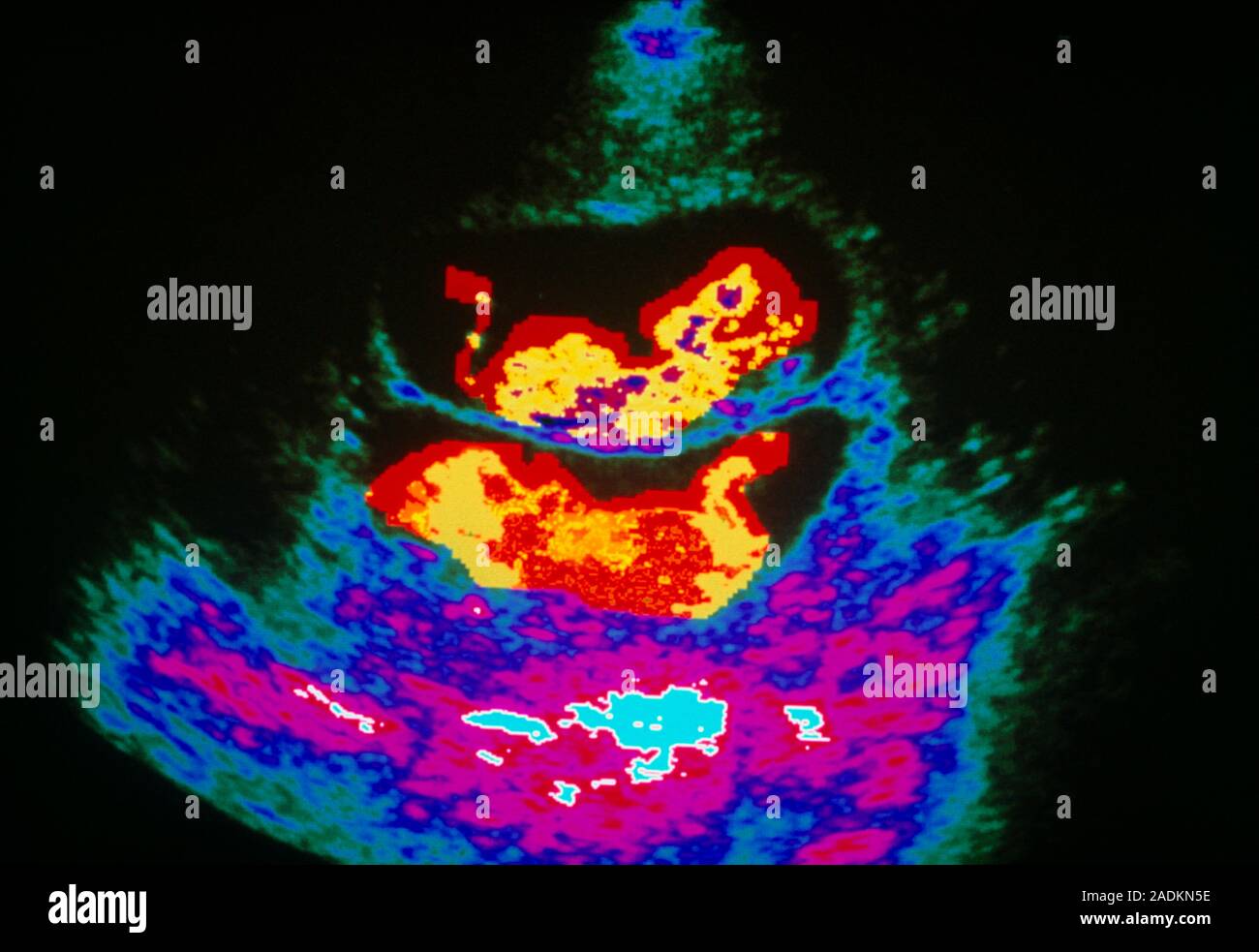 Foetal twins. Coloured ultrasound scan of the pregnant womb of a woman ...