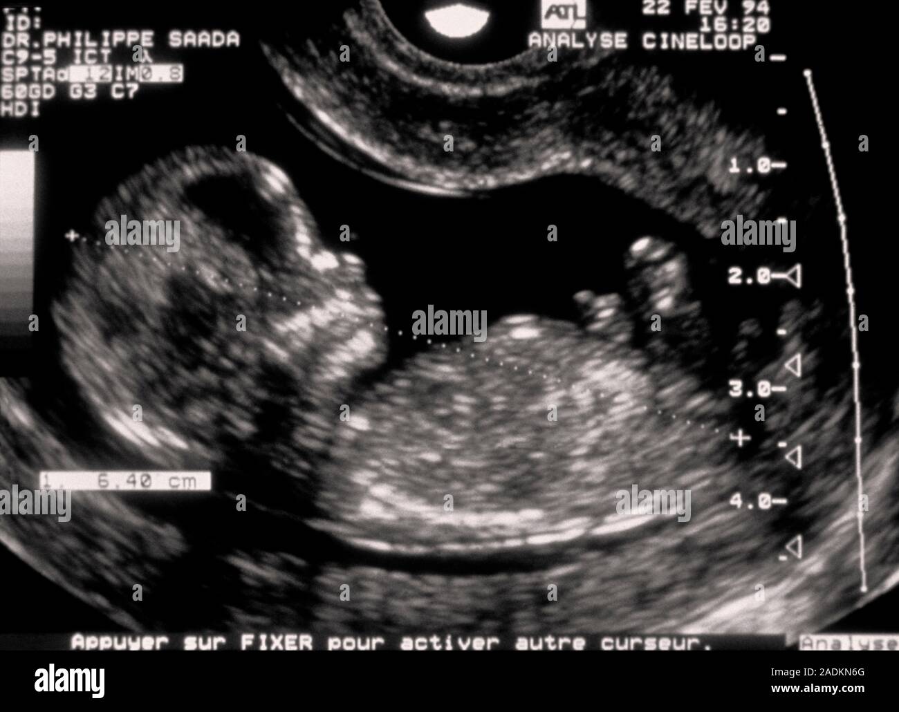 Profile of foetus. Ultrasound scan of the profile of a human foetus ...