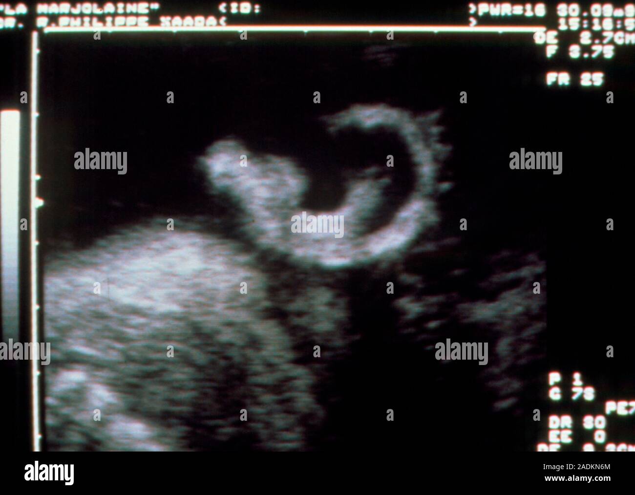 Ear of a foetus. Ultrasound scan showing the ear of a foetus aged 8 ...