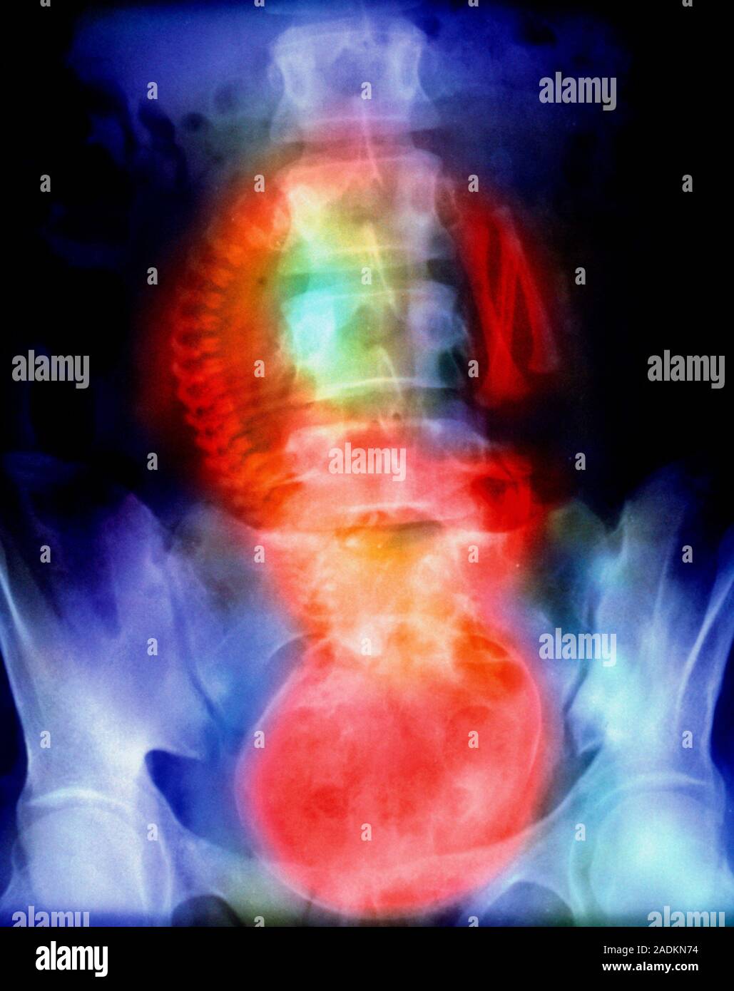 Full term foetus. Coloured X-ray of a full term (9 month or 40 week old ...