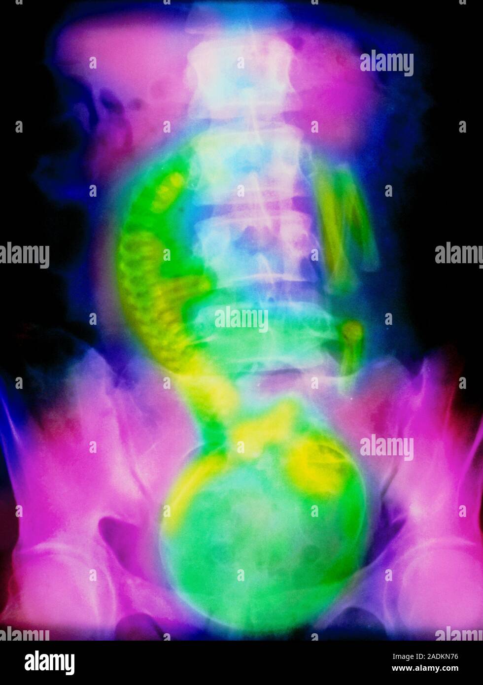 Full term foetus. Coloured X-ray of a full term (9 month or 40 week old ...