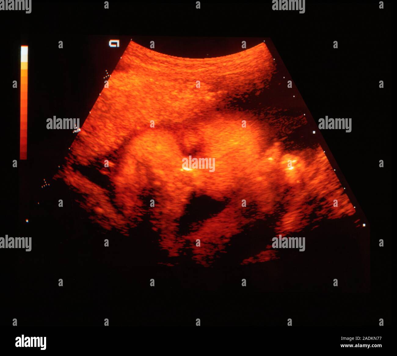 Face of a foetus. Ultrasound scan of a full-term (9 month old) foetus ...