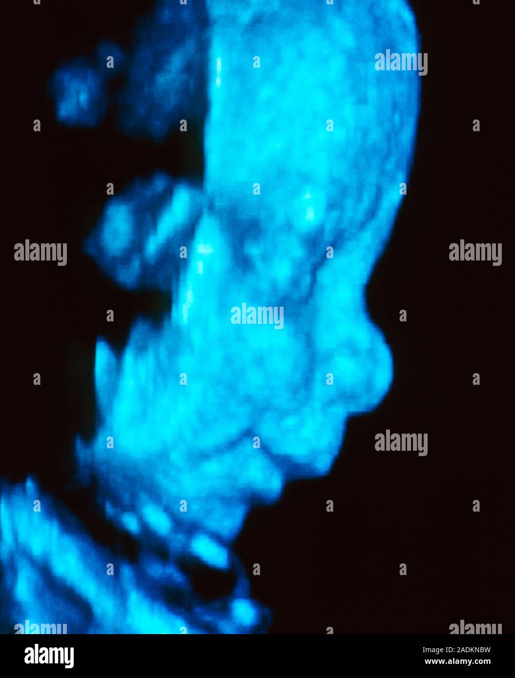 3-D foetal ultrasound. Coloured three-dimensional (3-D) ultrasound scan ...