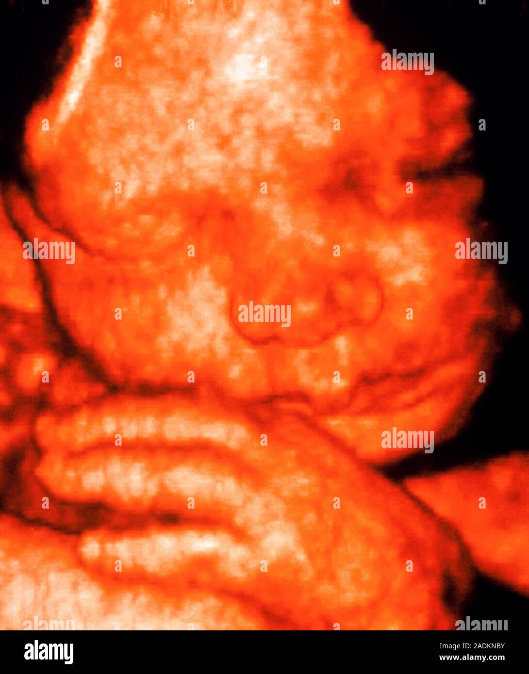 3-D foetal ultrasound. Coloured three-dimensional (3-D) ultrasound scan ...