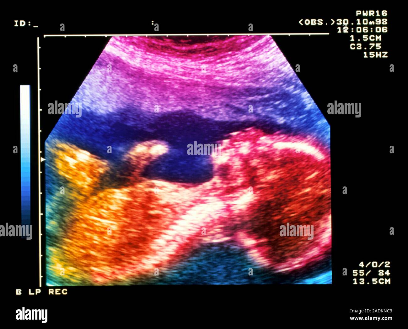 Twenty week old foetus. Coloured ultrasound scan of a 20 week (five ...