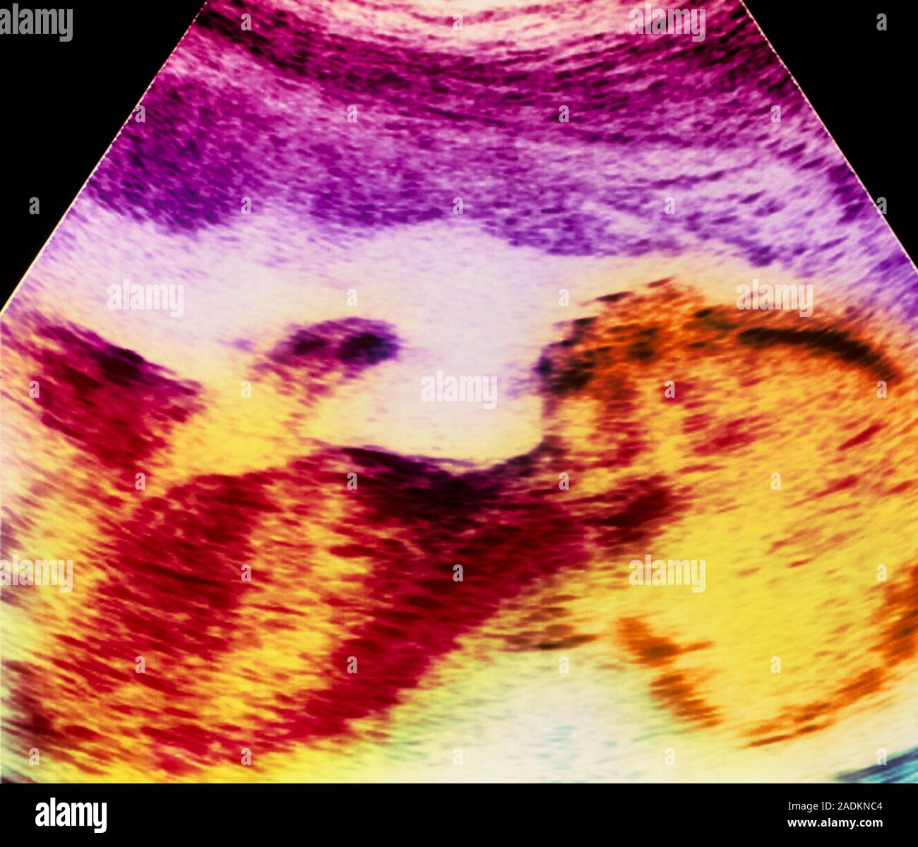 Twenty week old foetus. Coloured ultrasound scan of a 20 week (five ...