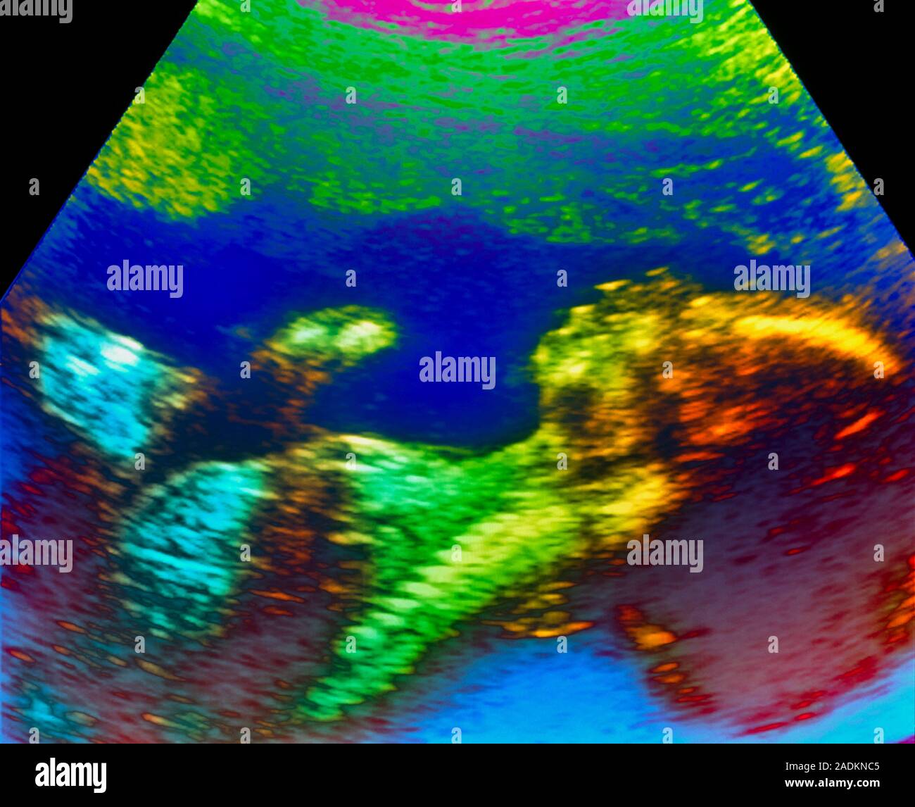 Twenty week old foetus. Coloured ultrasound scan of a 20 week (five ...