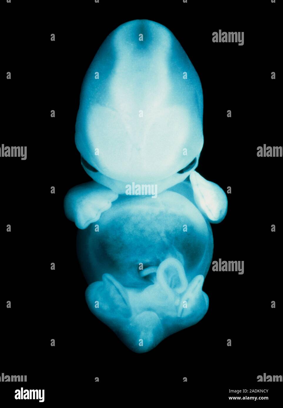 Human embryo. Coloured frontal view of a 6 week (44 day) old human ...