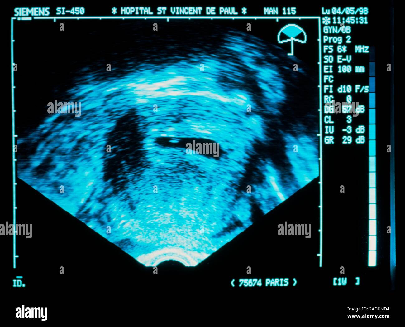 Embryo ultrasound scan. Ultrasound scan of an early embryo conceived ...