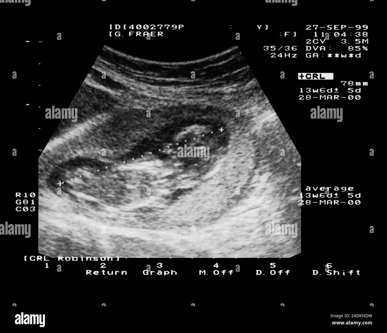 Foetus. Ultrasound scan of a healthy 12-week-old (3-month-old) human ...