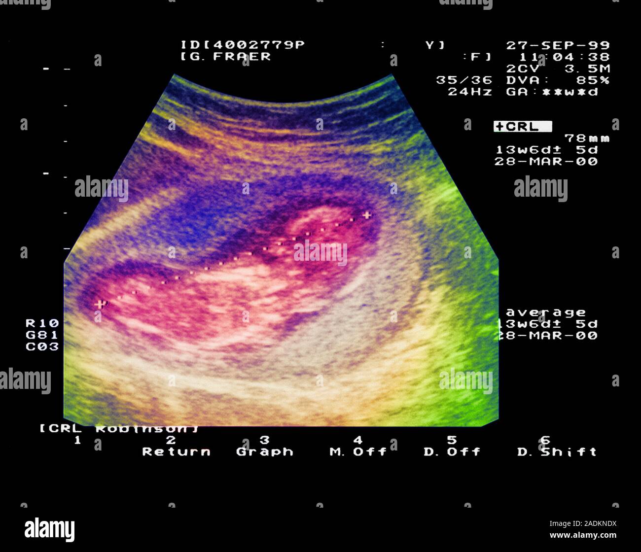 Foetus. Coloured ultrasound scan of a healthy 12- week-old (3-month-old ...
