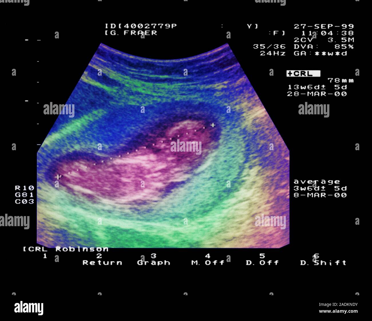 Foetus. Coloured ultrasound scan of a healthy 12- week-old (3-month-old ...