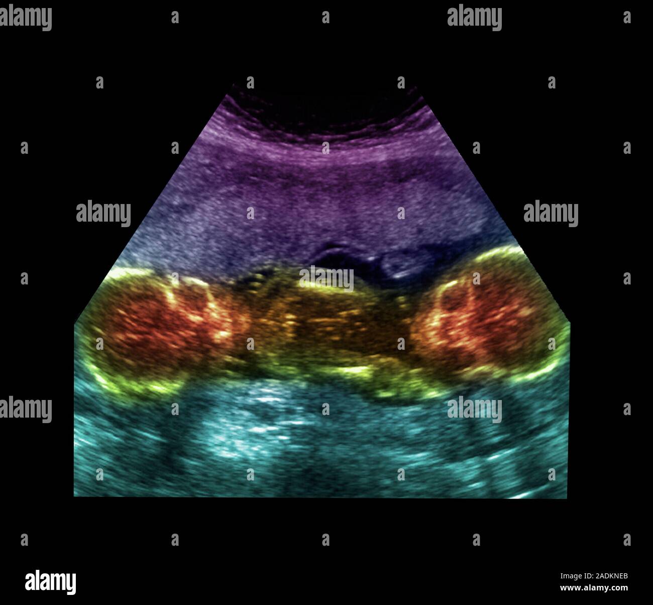 Twin foetuses. Coloured ultrasound scan of twin foetuses (orange ...