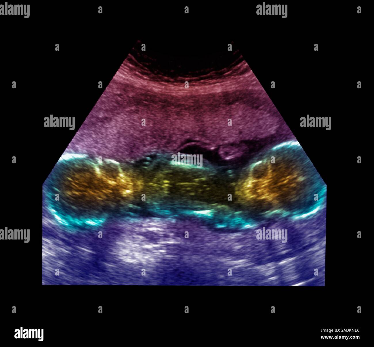 Twins Ultrasound 20 Weeks Fetal Anomaly Scan (18 – 22 Weeks)