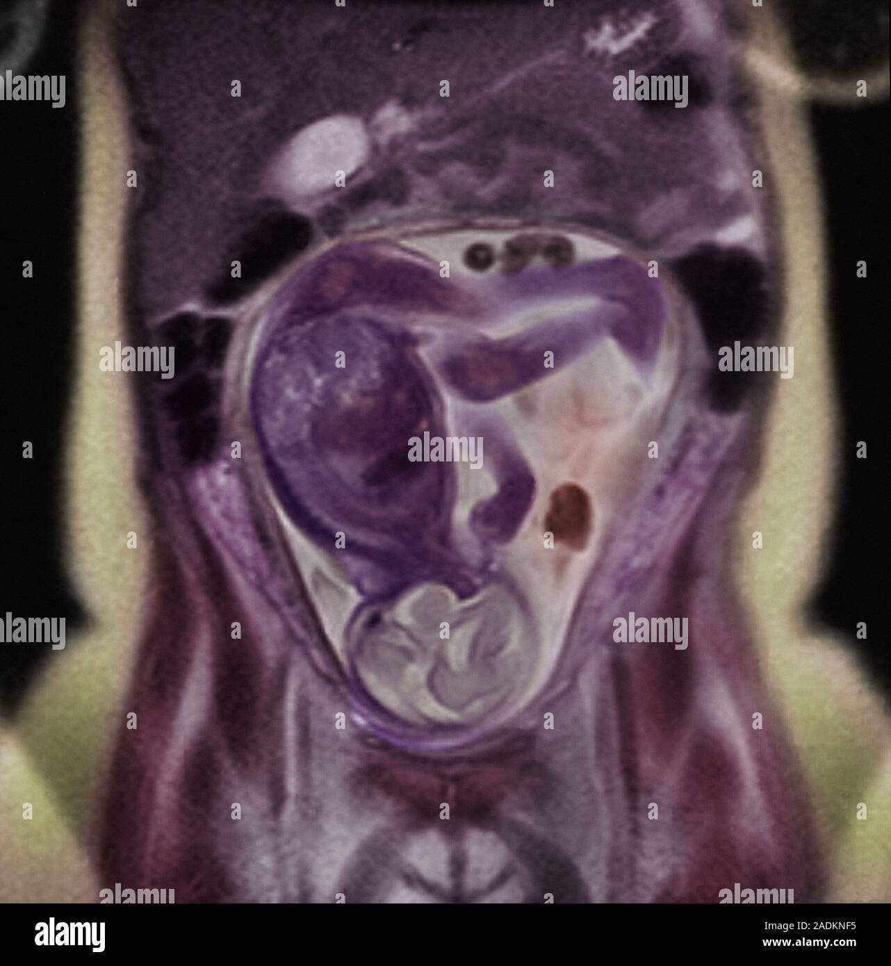 Foetus. Coloured magnetic resonance imaging (MRI) scan of a foetus ...