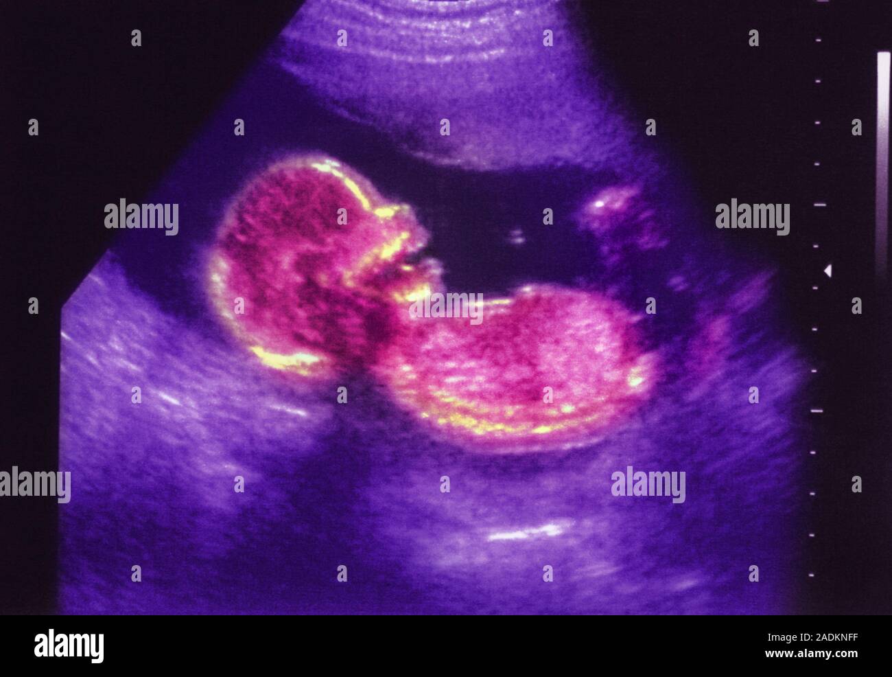 Foetus. Coloured ultrasound scan of a human foetus at 20 weeks of ...