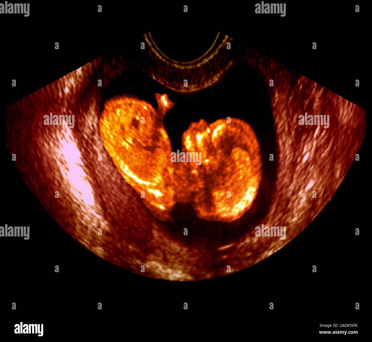 Foetus. Ultrasound scan of a healthy human foetus at 37 weeks, near to ...