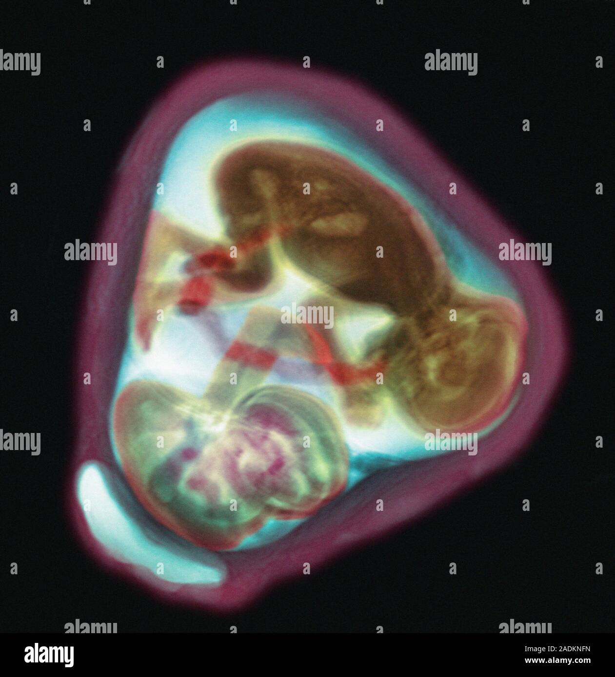 Twin foetuses. Coloured magnetic resonance imaging (MRI) scan of 32 ...