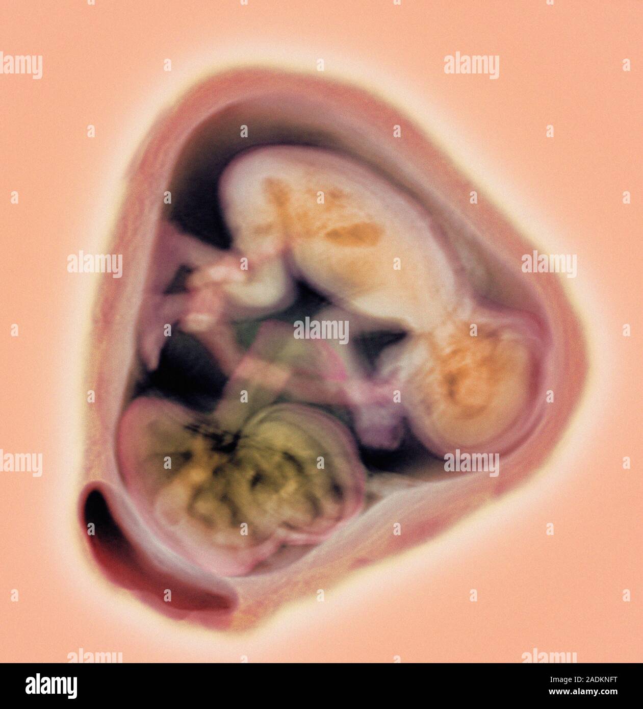 Twin foetuses. Coloured magnetic resonance imaging (MRI) scan of 32 ...