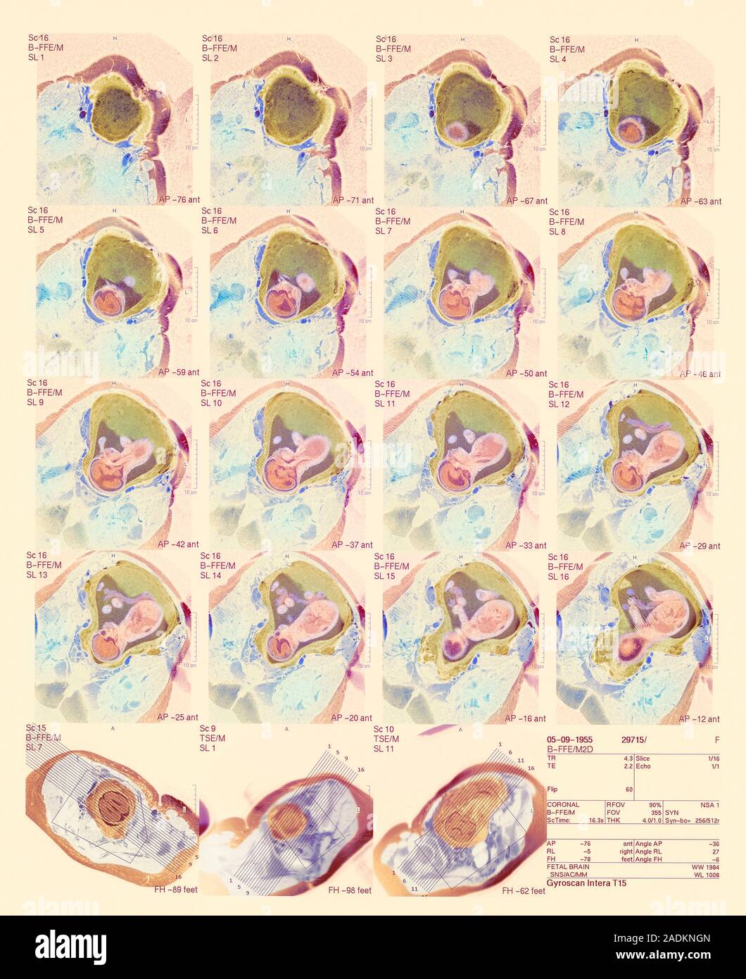 Foetus at 27 weeks, sequence of coloured magnetic resonance imaging ...
