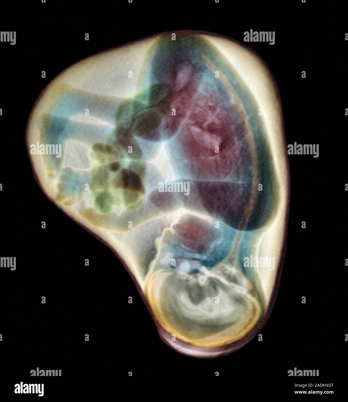 Foetus at 27 weeks, coloured three-dimensional magnetic resonance ...
