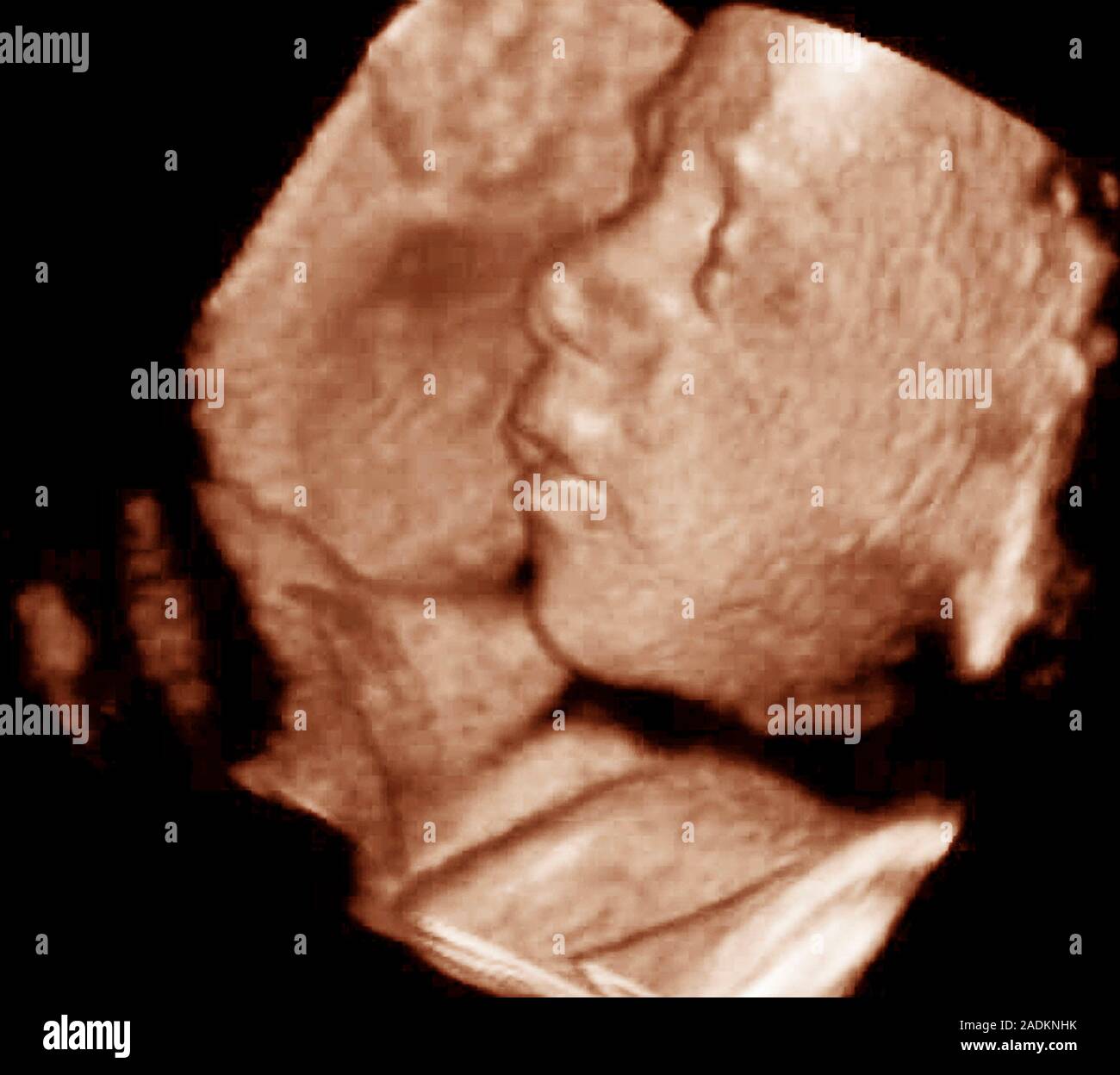 Foetal ultrasound. Three-dimensional (3-D) ultrasound scan of the face ...