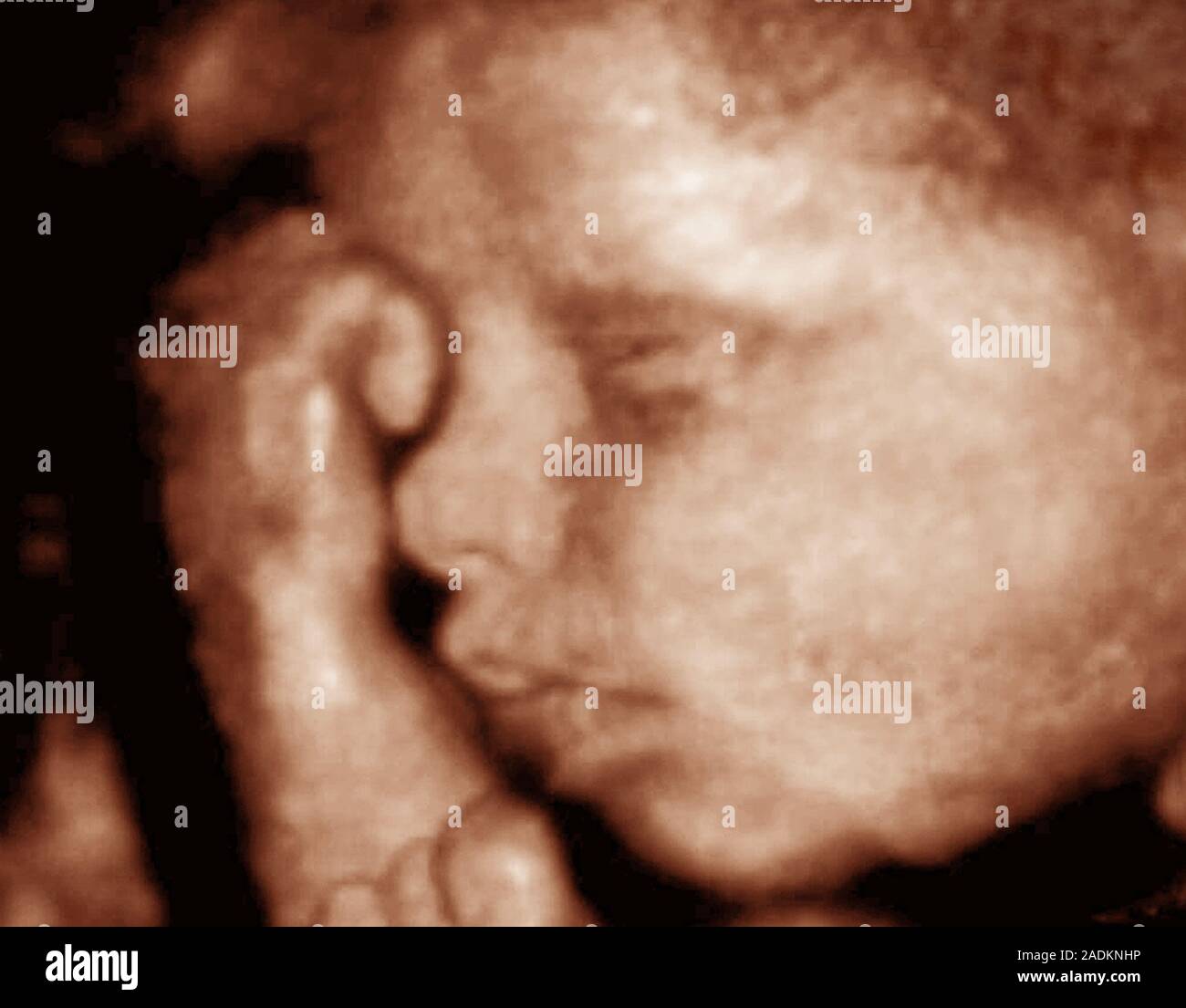 Foetal ultrasound. Three-dimensional (3-D) ultrasound scan of the face ...