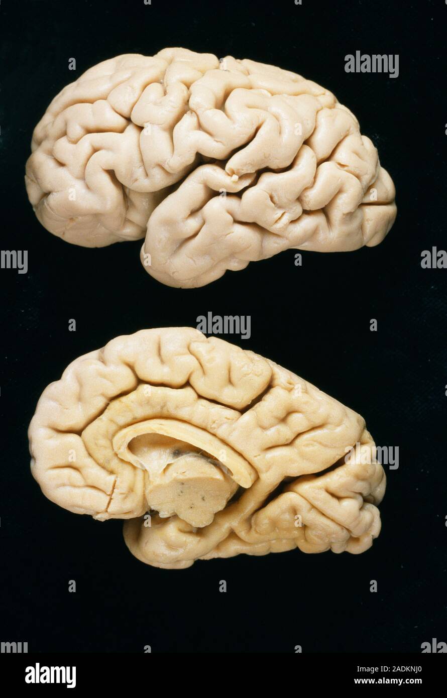 Neonatal brains. Gross clinical specimens of two neonatal, human brains ...