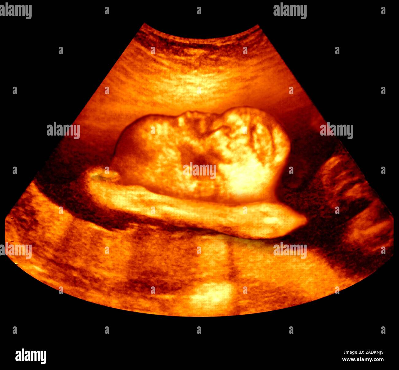 Foetal ultrasound. 3-D ultrasound scan of the face and forearm of a ...