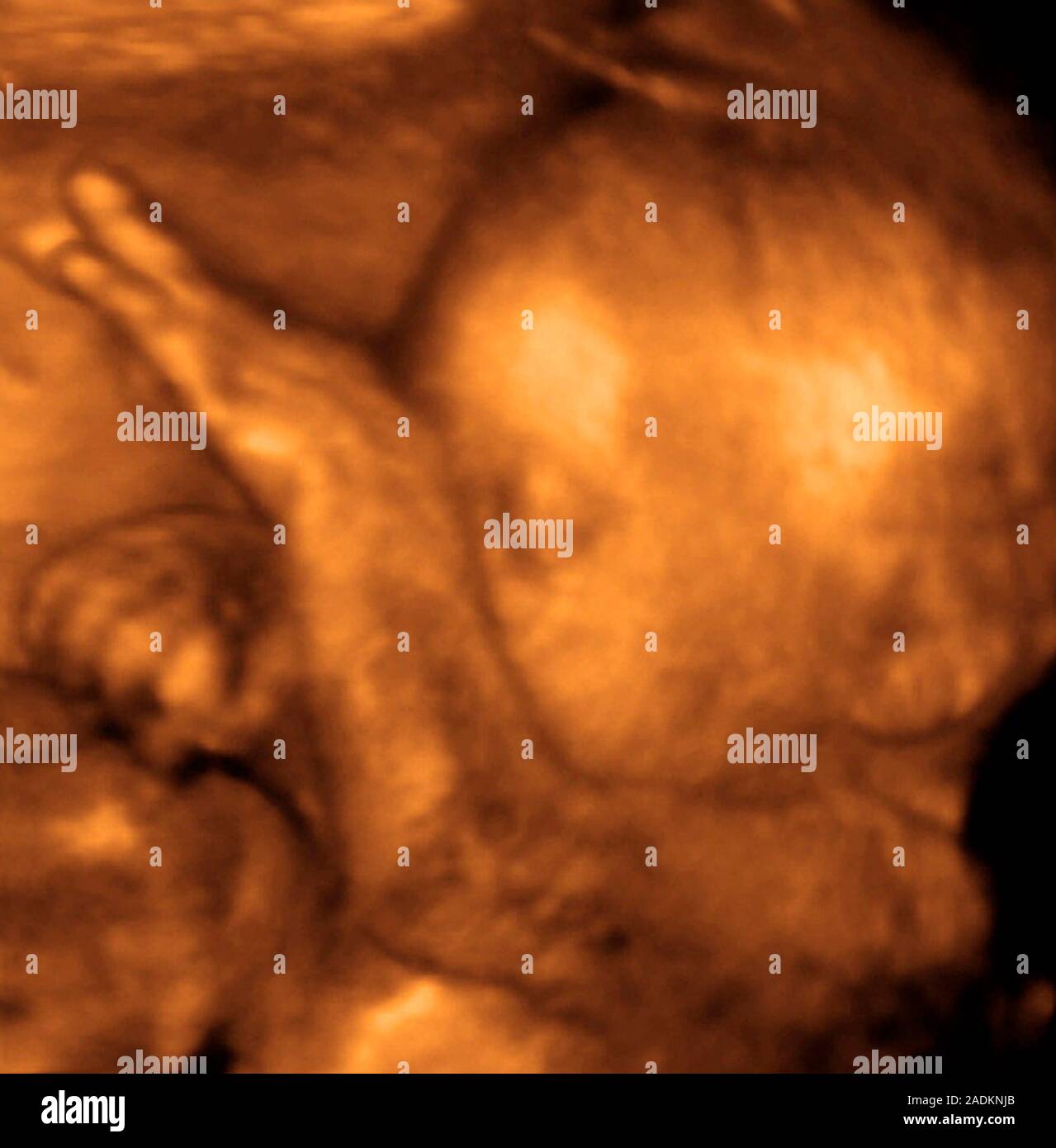 Foetus. Coloured 3-D ultrasound scan of a foetus with its arms crossed ...