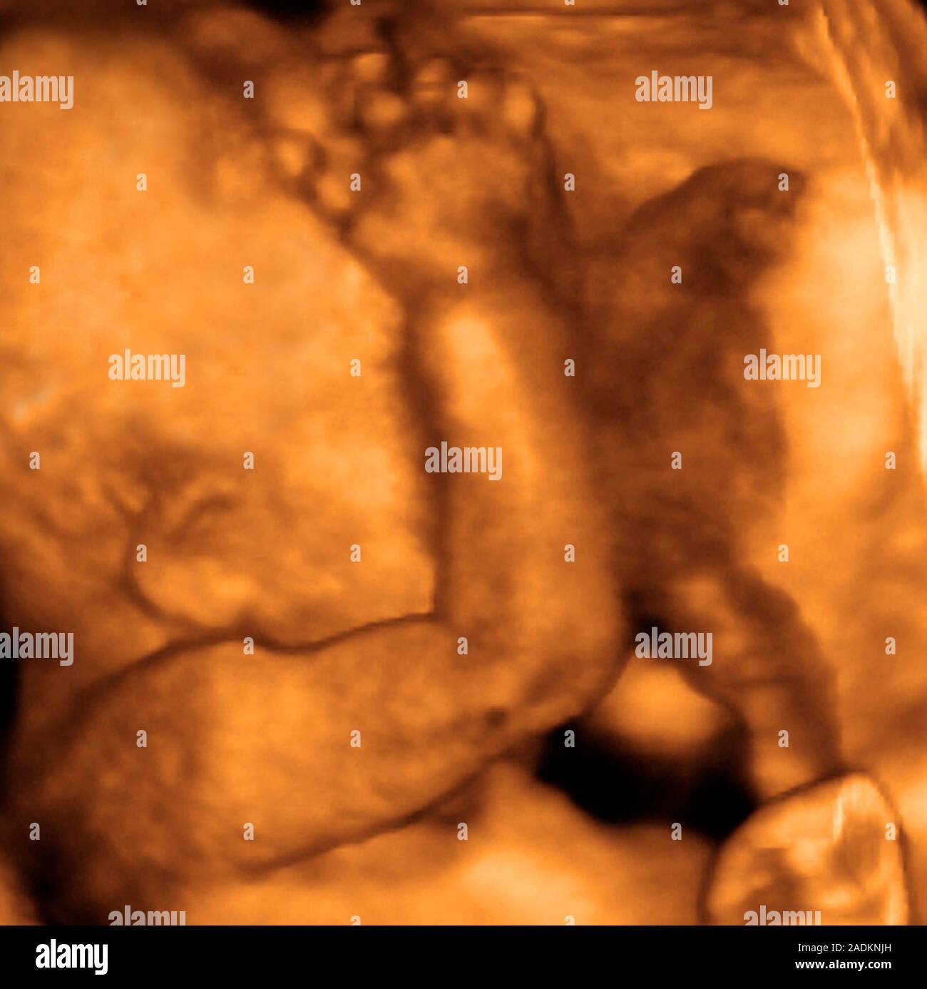 Foetus. Coloured 3-D ultrasound scan of a foetus with its arm across ...