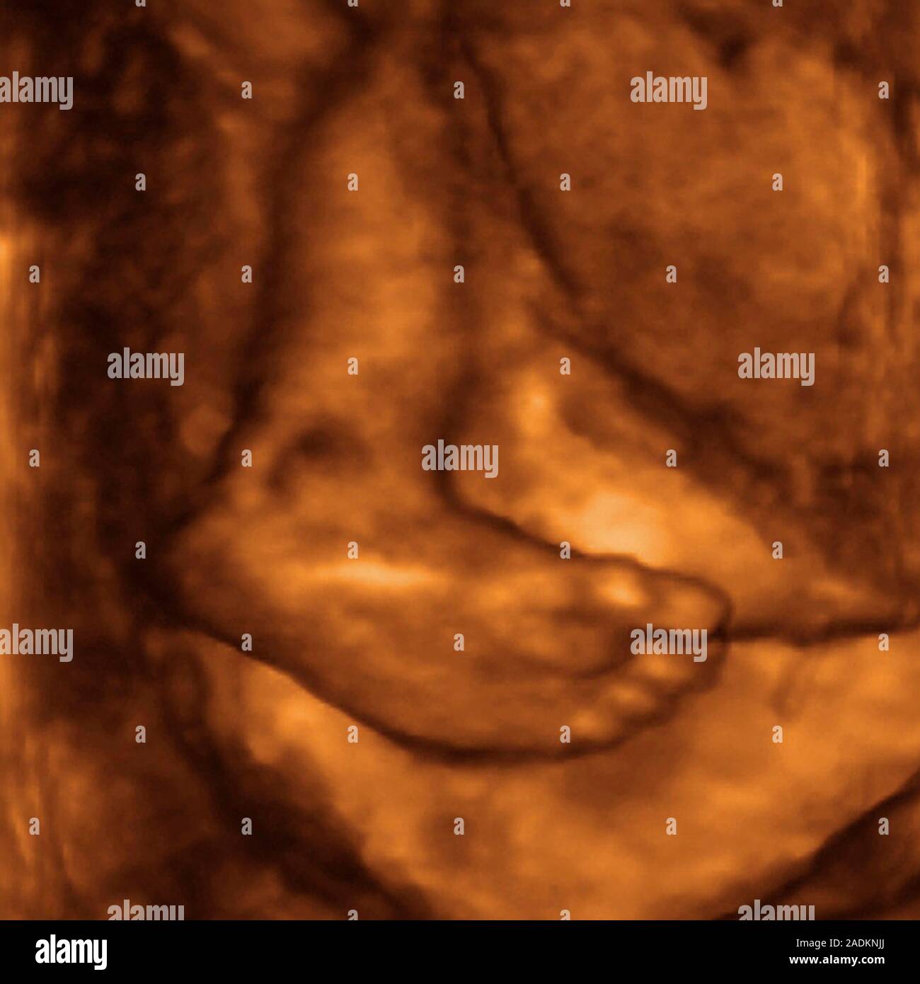 Foetus' foot. Coloured 3-D ultrasound scan of the foot of a foetus ...