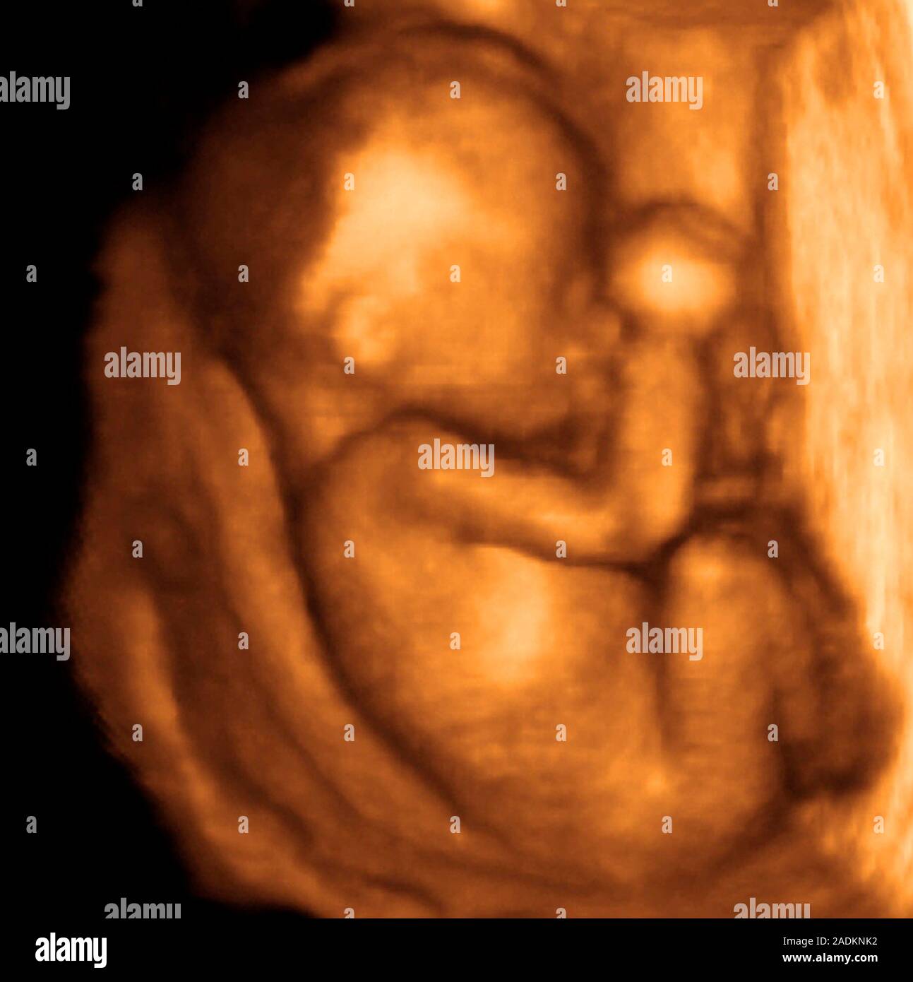 Foetus. Coloured 3-D ultrasound scan of a foetus during the second ...