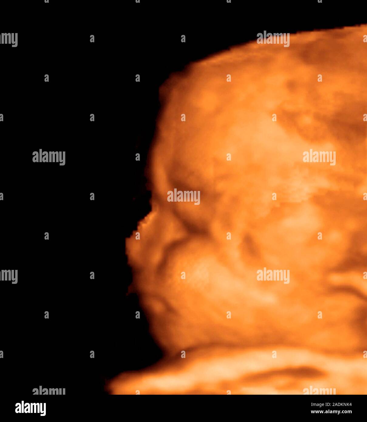 Foetus. Coloured 3-D ultrasound scan of the face of a foetus in profile ...