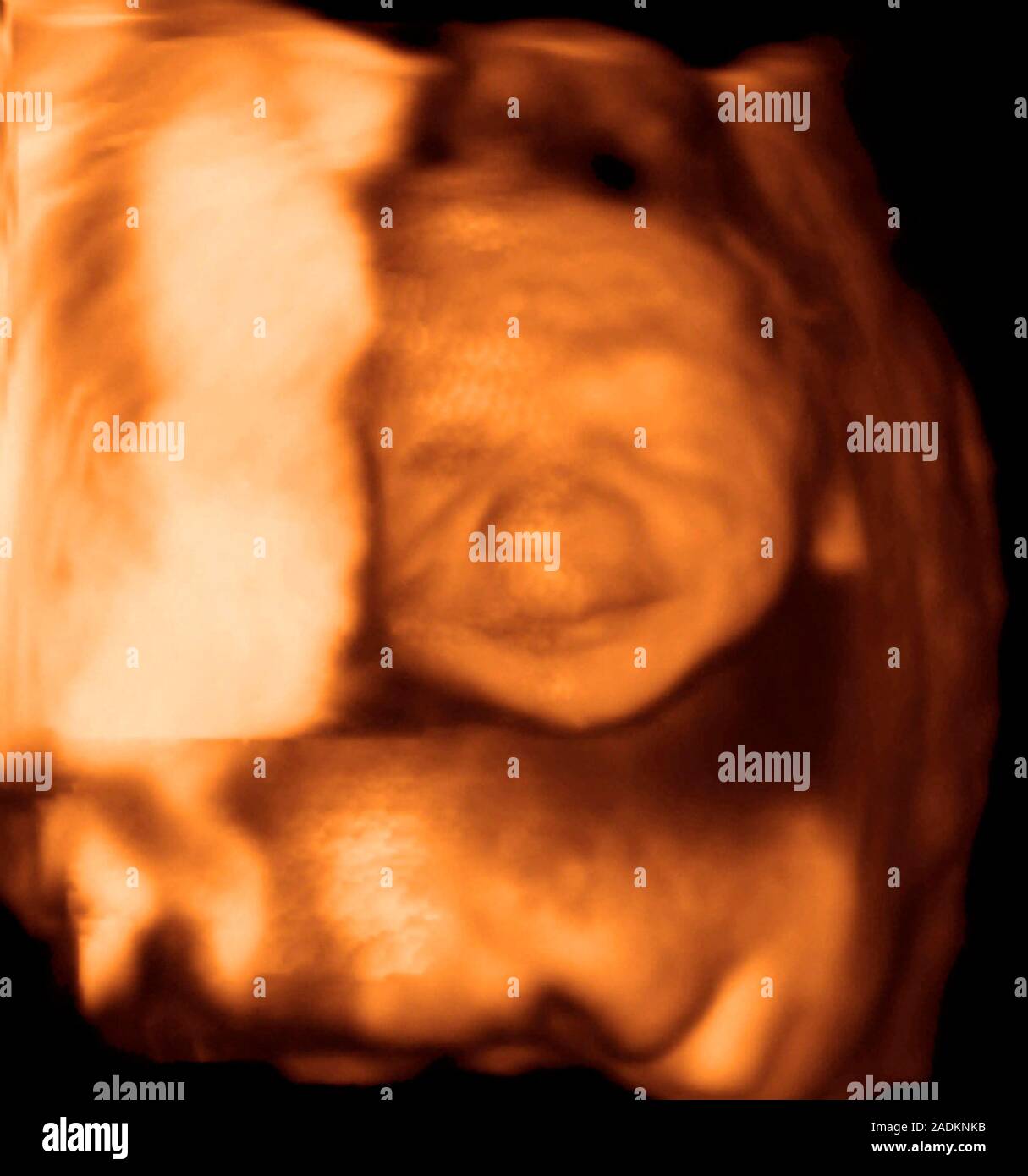 Foetus. Coloured 3-D ultrasound scan of the face of a foetus ...