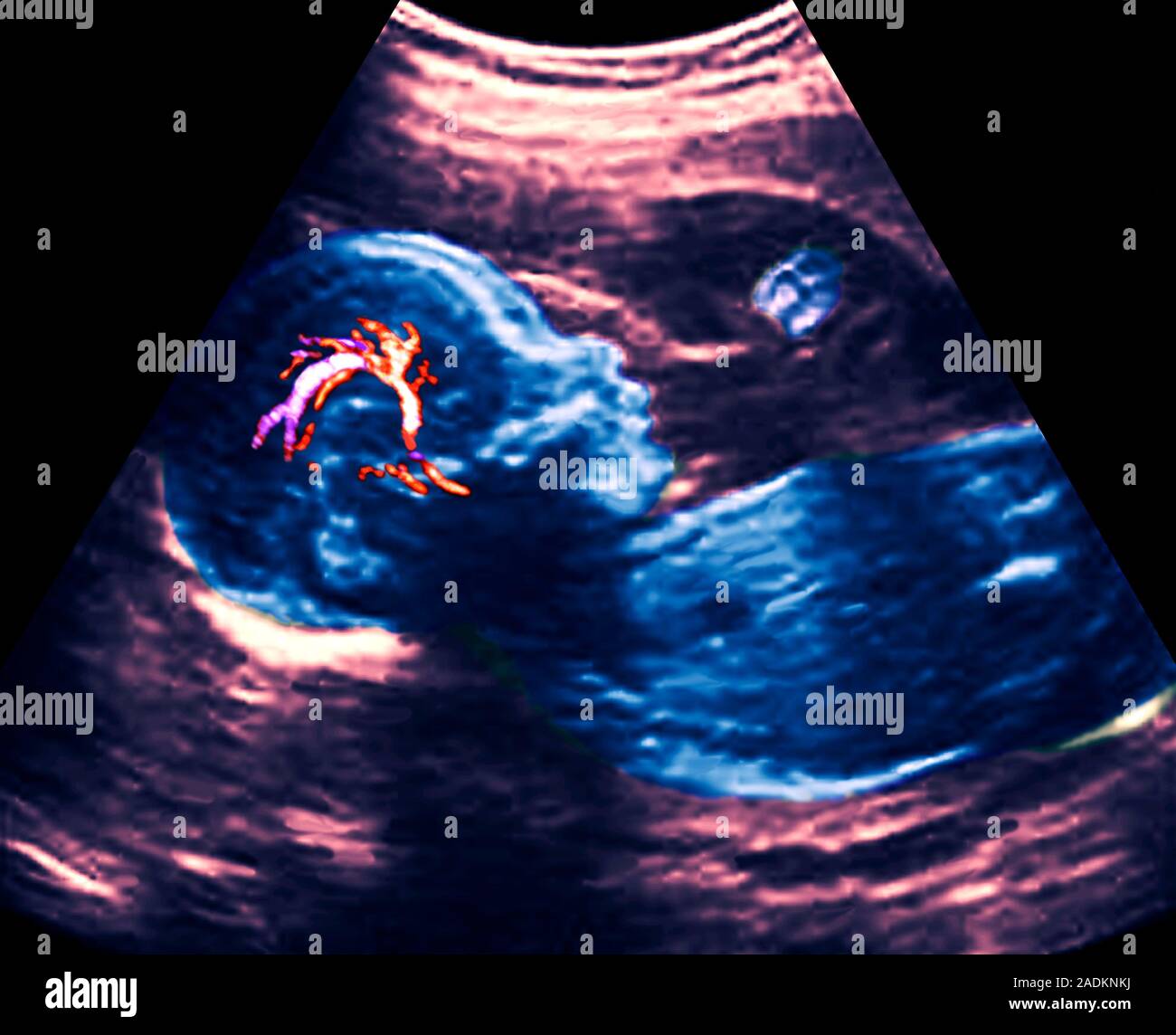 Foetal blood flow. Coloured doppler ultrasound scan showing the blood ...