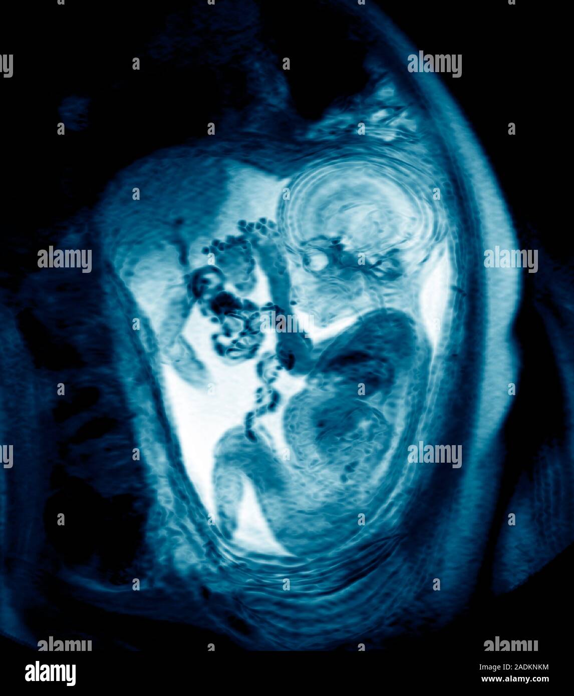 Foetus. Coloured 3-dimensional magnetic resonance imaging (MRI) scan of ...
