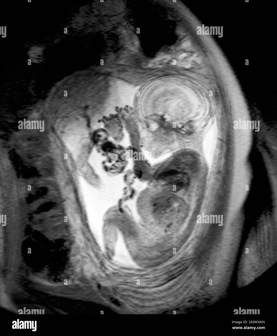 Foetus. Coloured 3-dimensional magnetic resonance imaging (MRI) scan of ...