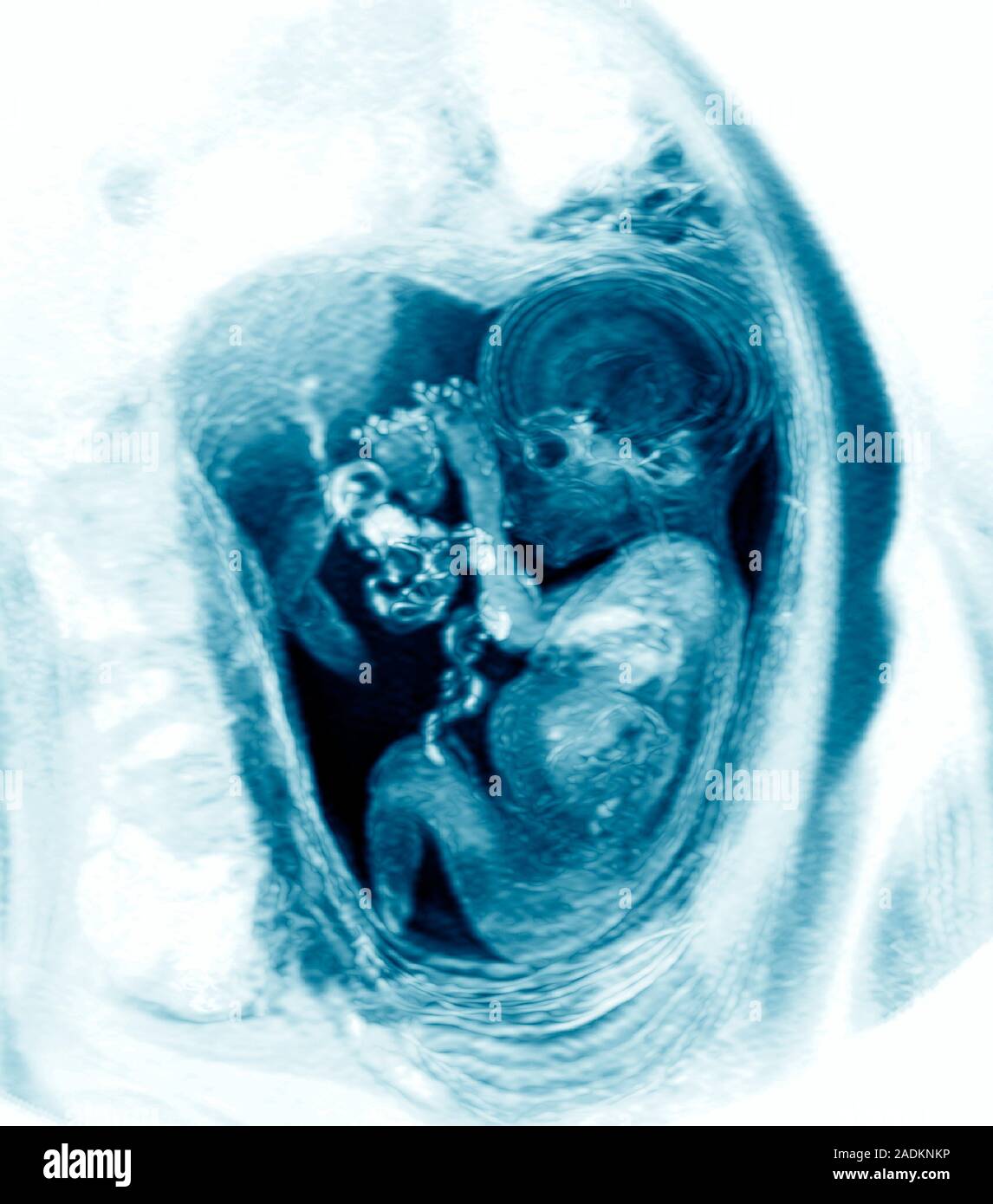 Foetus. Coloured 3-dimensional magnetic resonance imaging (MRI) scan of ...