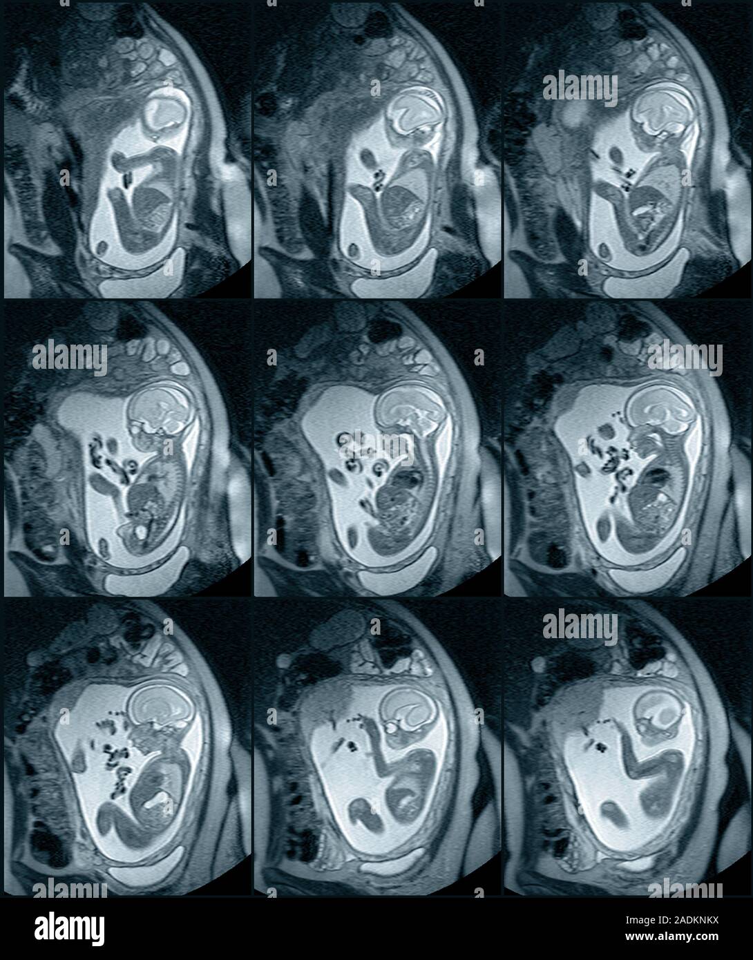 Foetus. Coloured magnetic resonance imaging (MRI) scans of a healthy ...