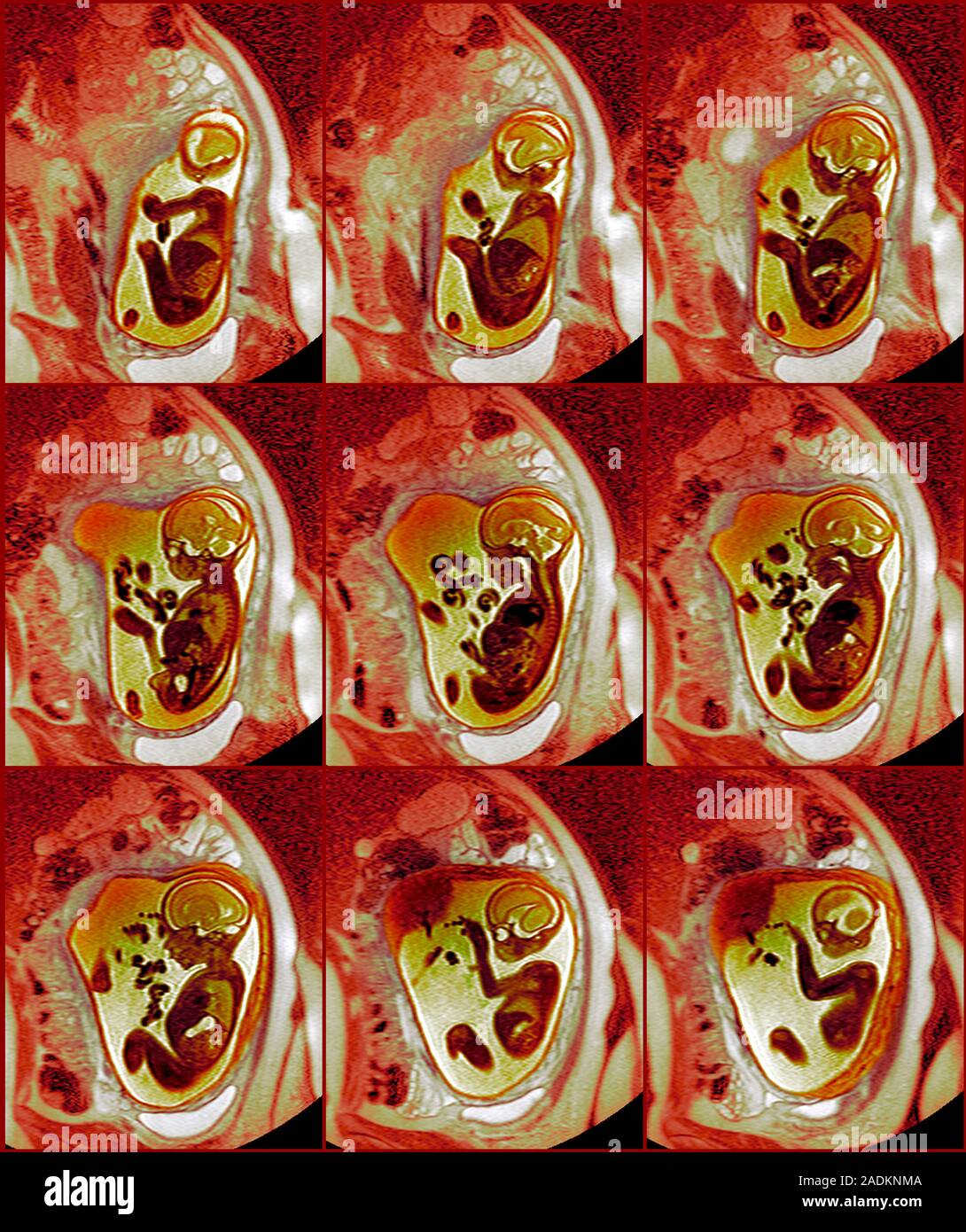 Foetus. Coloured magnetic resonance imaging (MRI) scans of a healthy ...