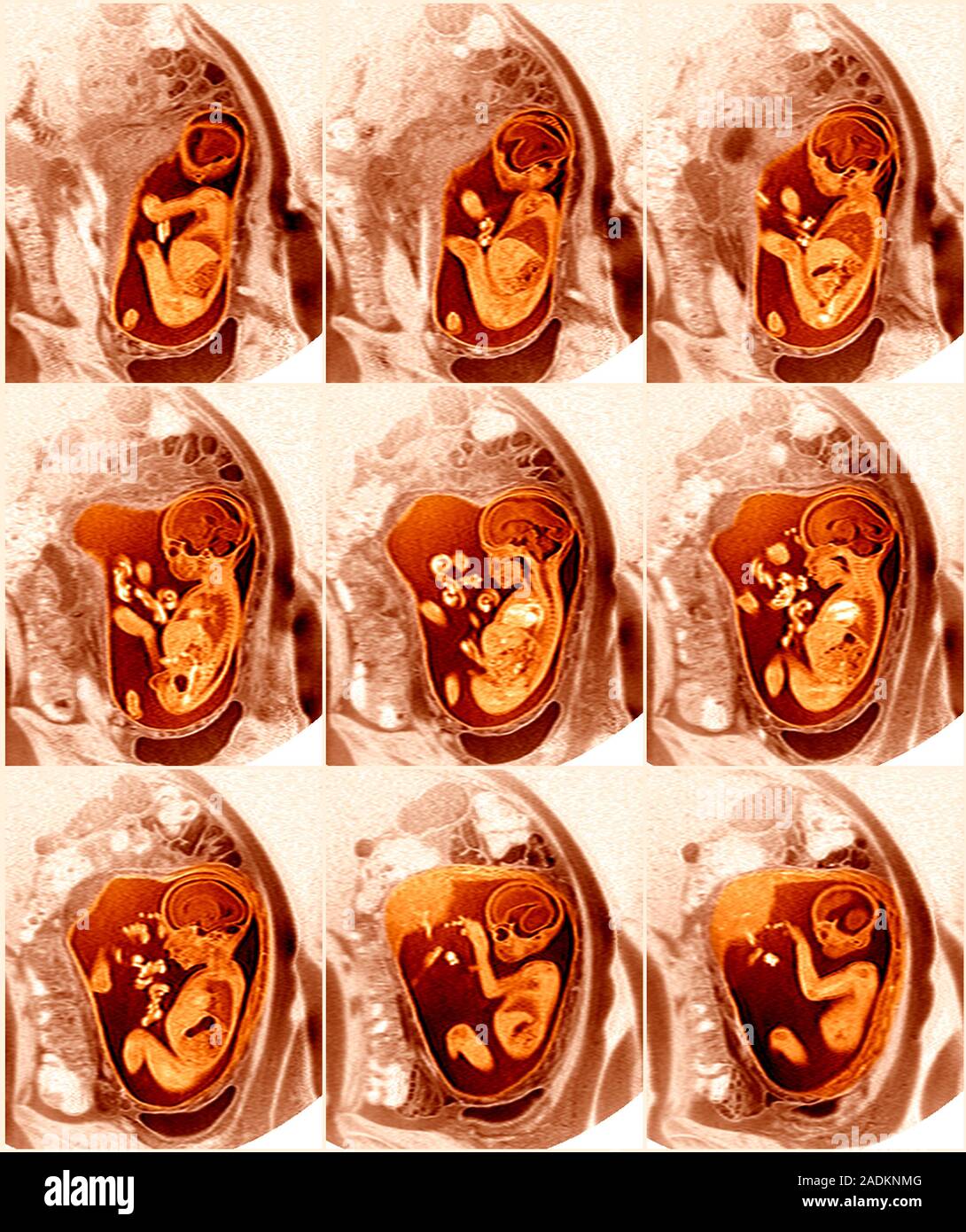 Foetus. Coloured magnetic resonance imaging (MRI) scans of a healthy ...