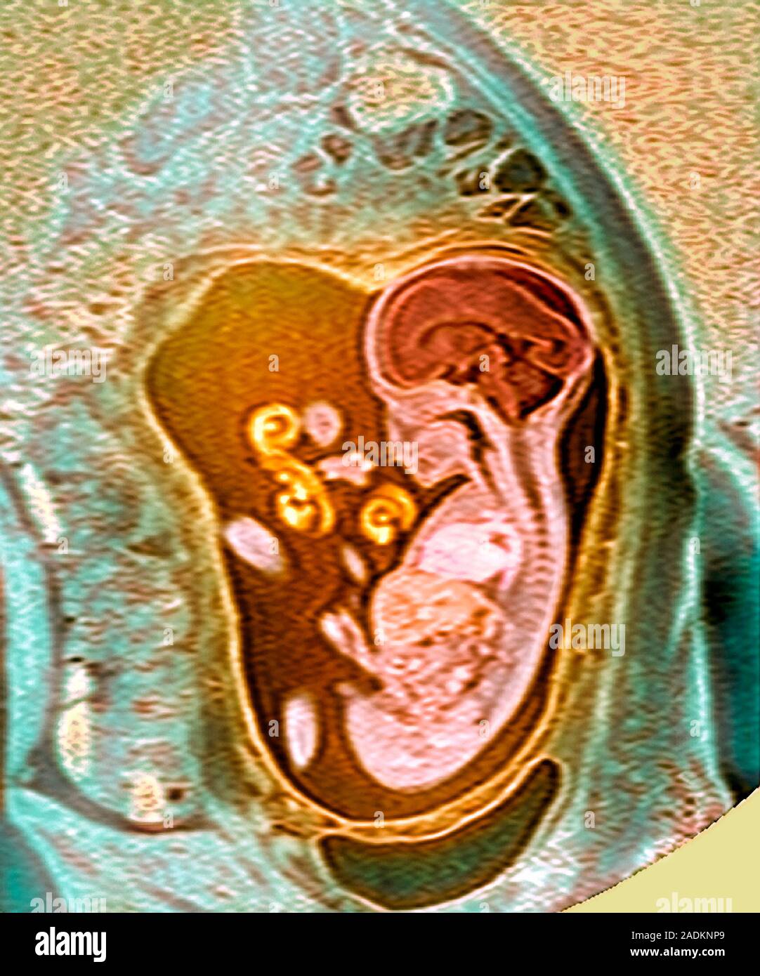 Foetus. Sagittal (side) coloured magnetic resonance imaging (MRI) scan ...