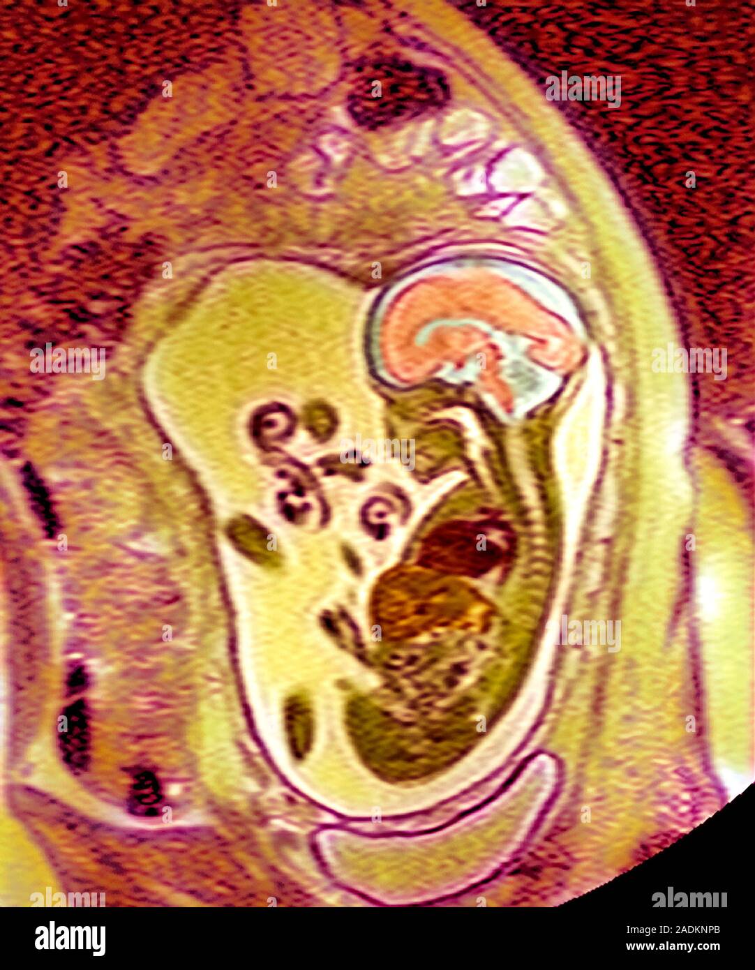 Foetus. Sagittal (side) coloured magnetic resonance imaging (MRI) scan ...