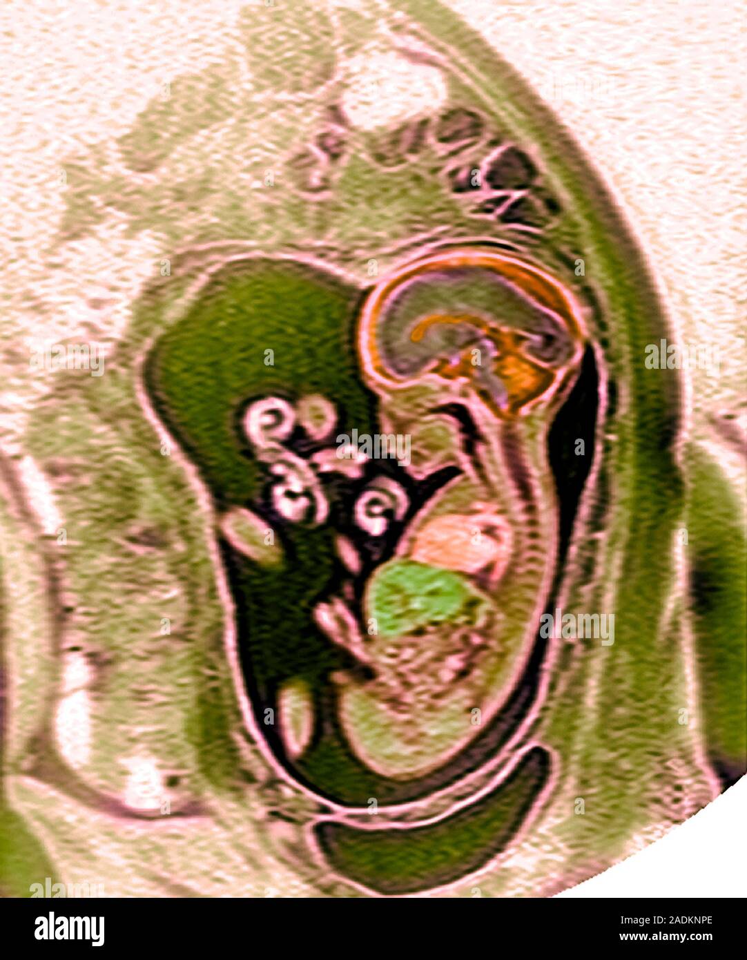 Foetus. Sagittal (side) coloured magnetic resonance imaging (MRI) scan ...