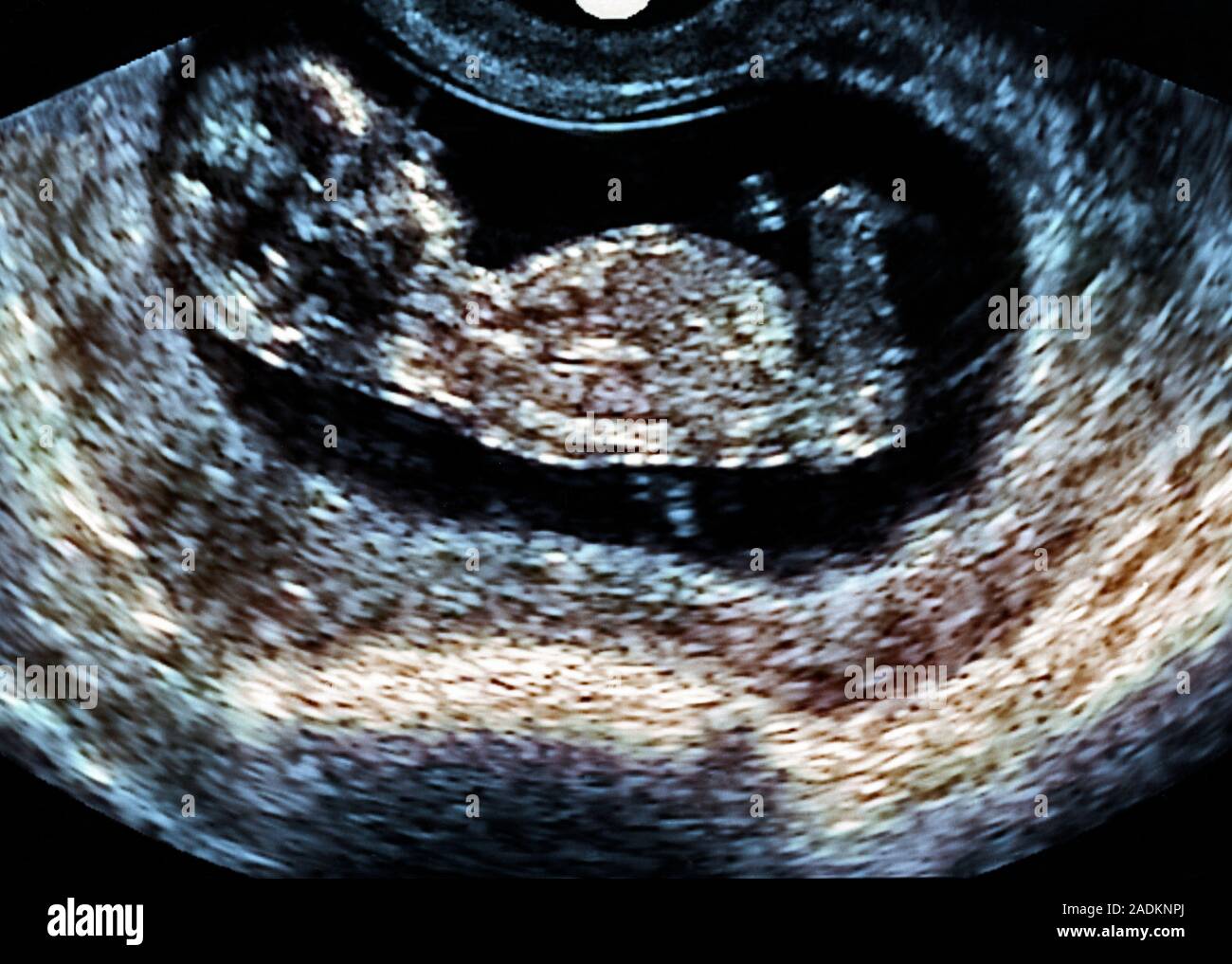 Foetal ultrasound scan of an 11-week-old foetus. At this stage of the ...