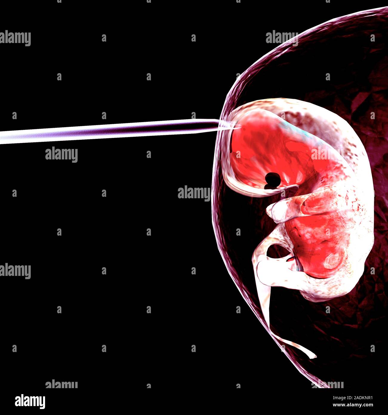 Embryo research. Computer artwork of a needle entering the amniotic sac ...