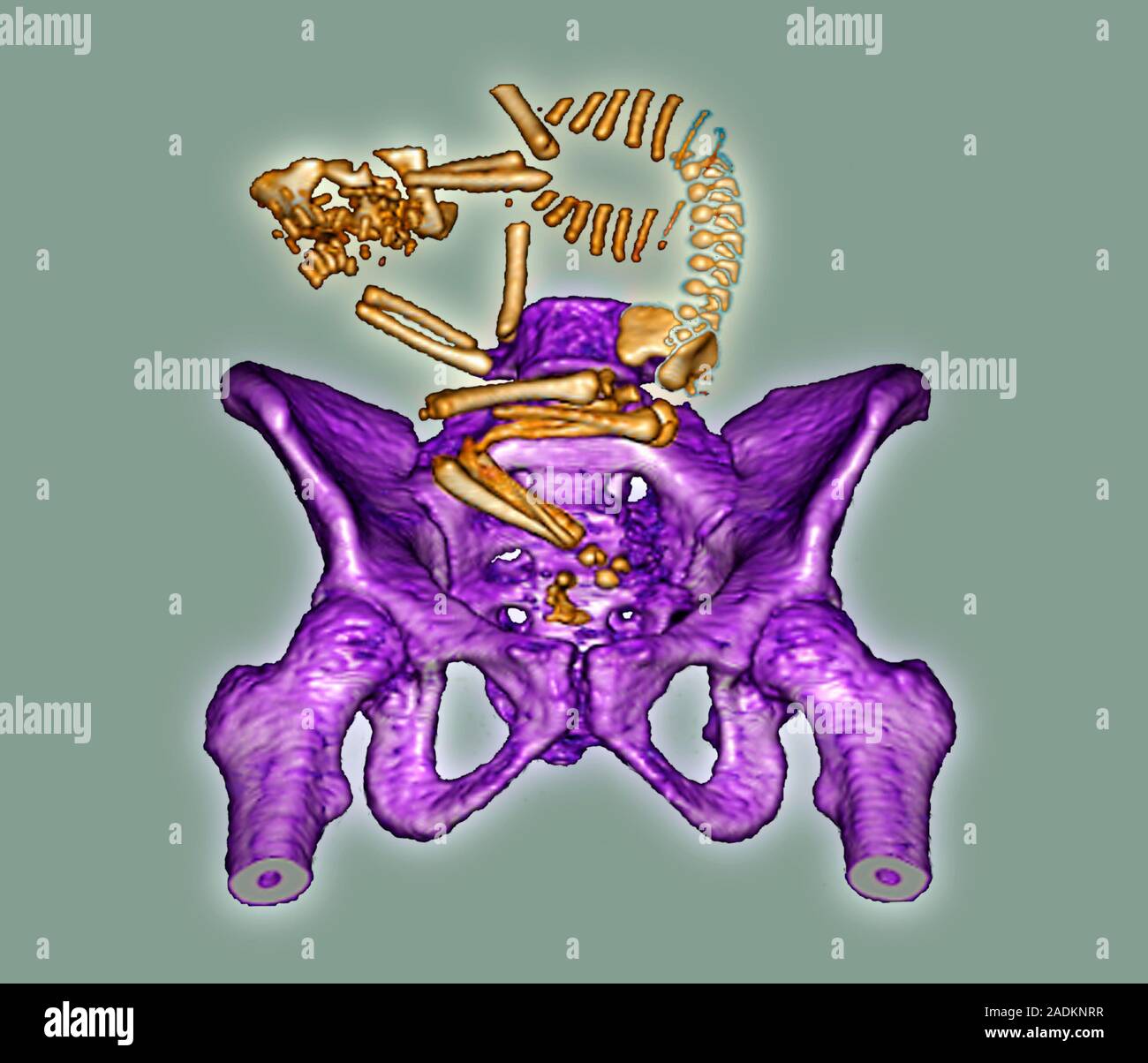 Breech position foetus. Coloured 3D computed tomography (CT) scan of a ...
