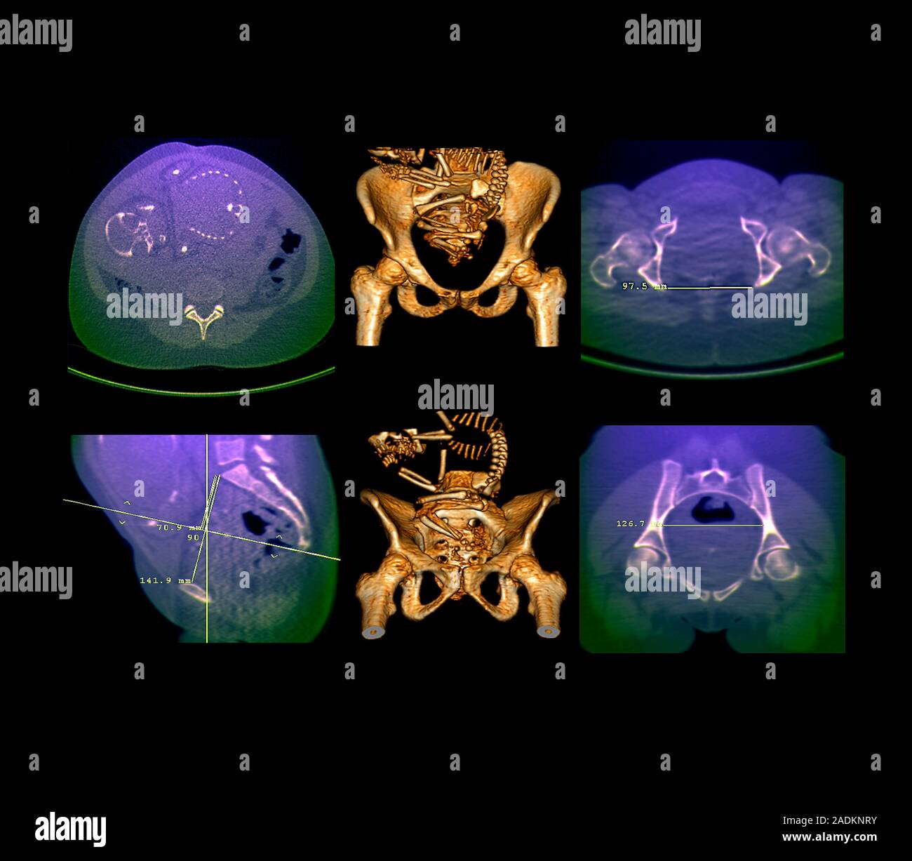 Breech position foetus. Coloured 3D (centre) and 2D computed tomography ...
