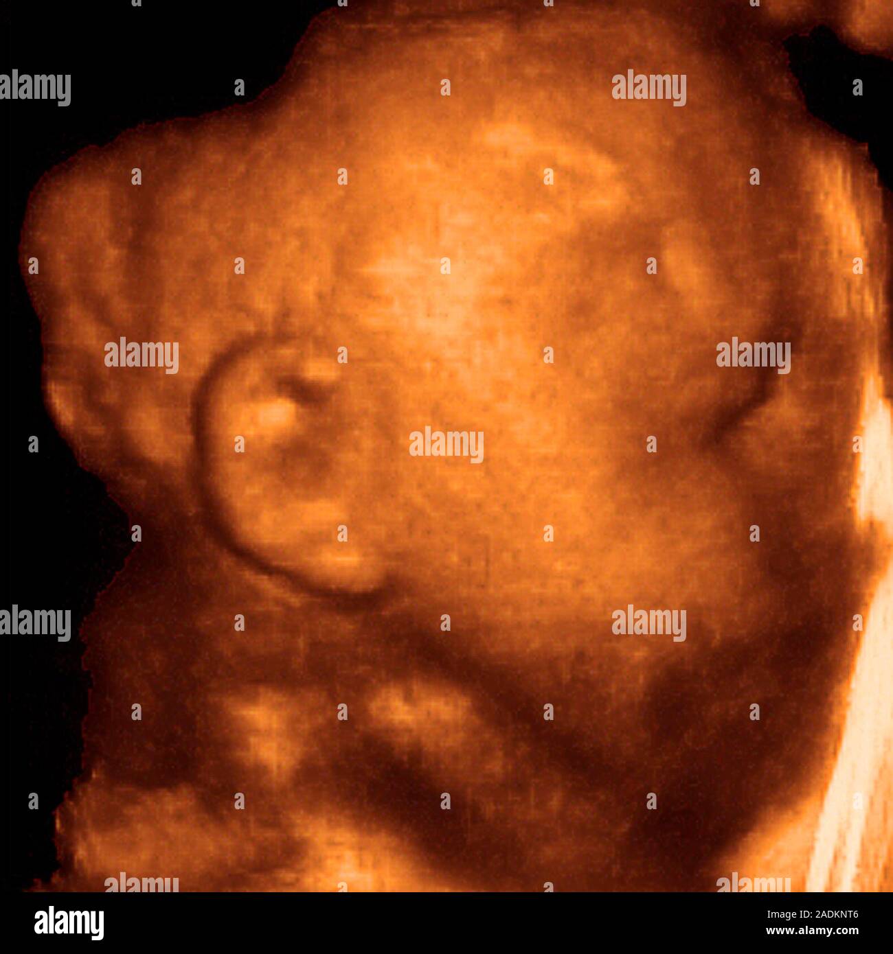 Foetus's head. Coloured 3-D ultrasound scan of a foetus' head in ...